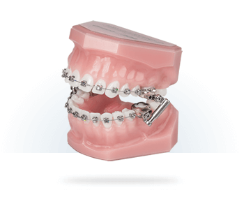 AdvanSync™2 - Perform Class II Correction to a New Standard