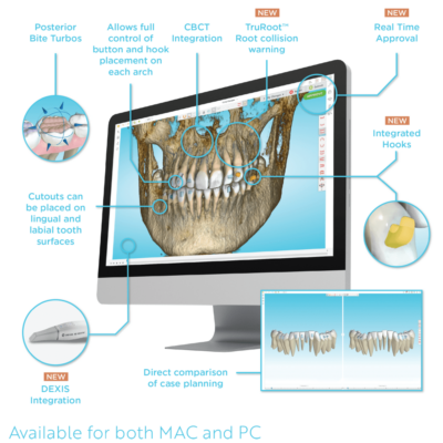 Ormco - Spark™ - Innovative & Advanced Clear Aligner System