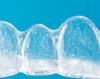 Ormco - Spark™ - Innovative & Advanced Clear Aligner System