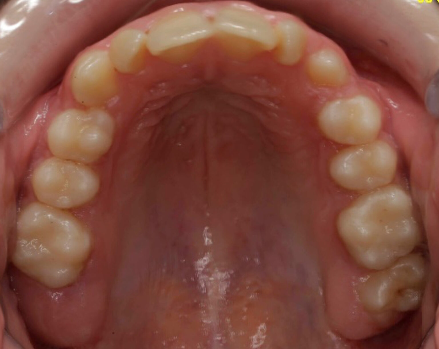 Managing partially erupted teeth with Spark Clear Aligners - Ormco