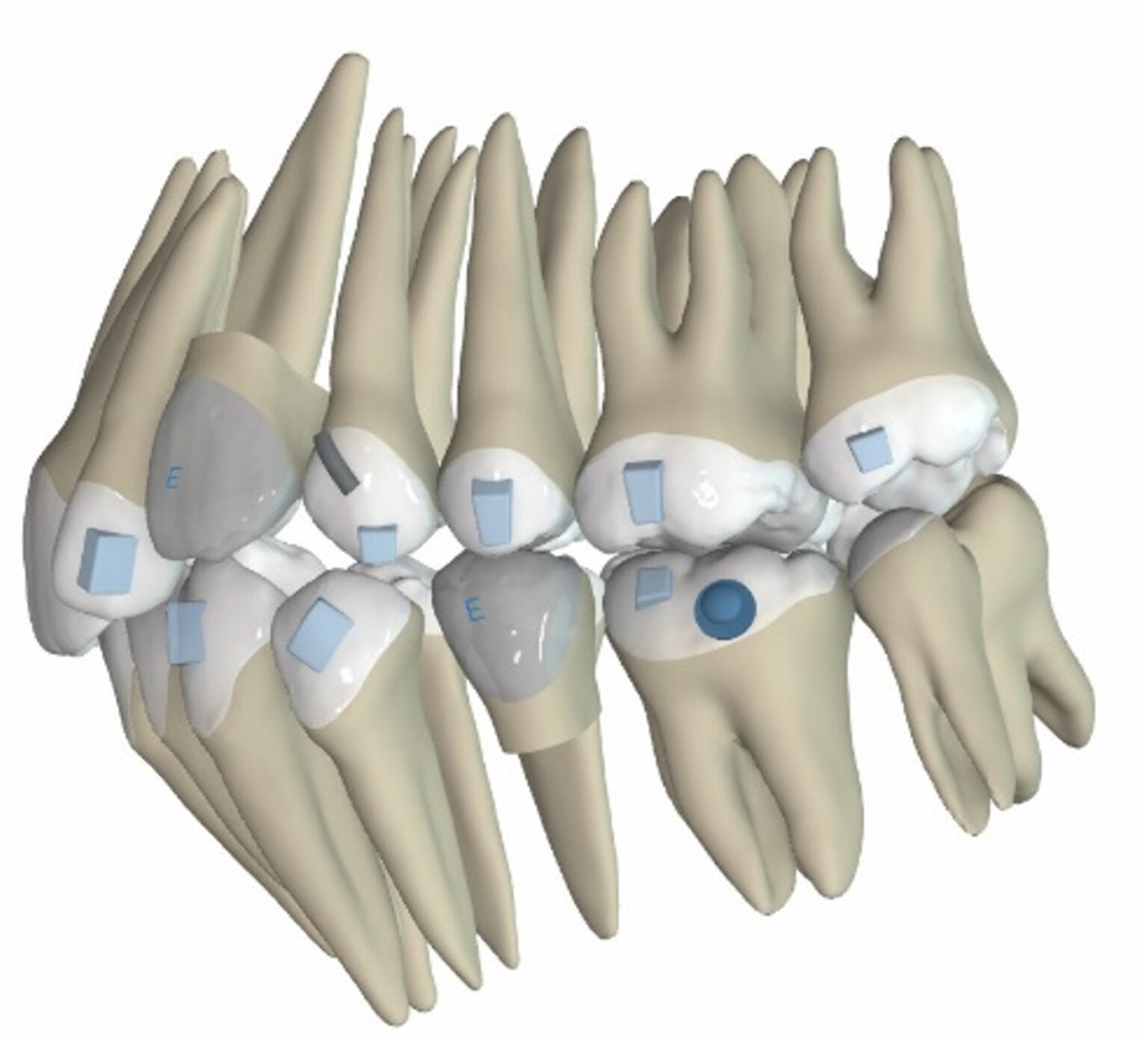 Managing partially erupted teeth with Spark Clear Aligners - Ormco