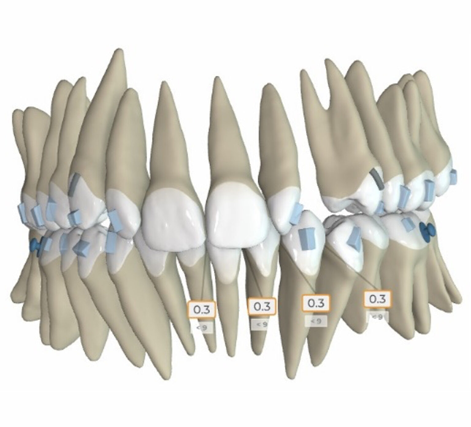 Managing partially erupted teeth with Spark Clear Aligners - Ormco