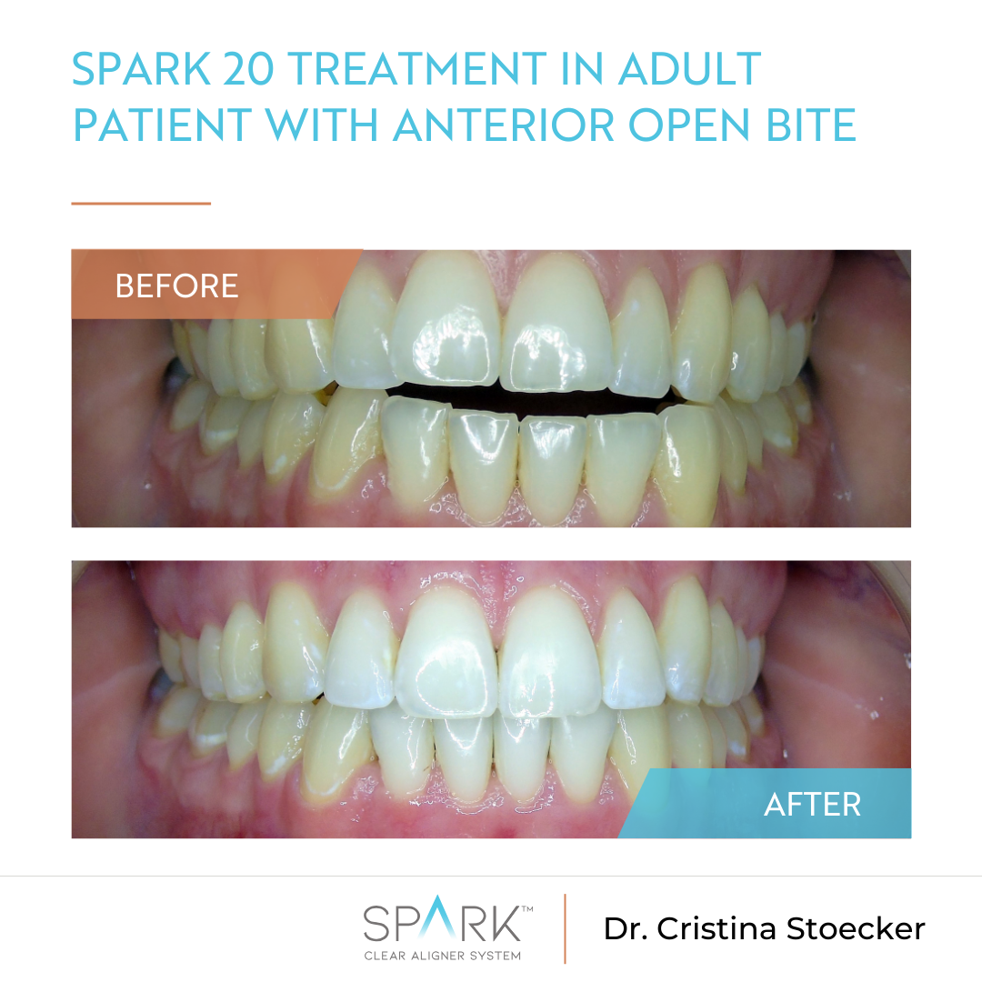 Spark 20 treatment in adult patient with anterior open bite - Ormco