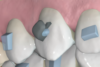 Ormco - Spark™ - Innovative & Advanced Clear Aligner System