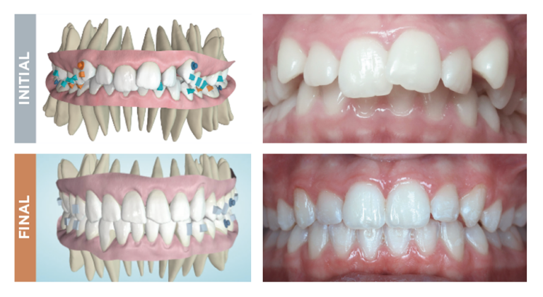 Ormco - Spark™ - Innovative & Advanced Clear Aligner System