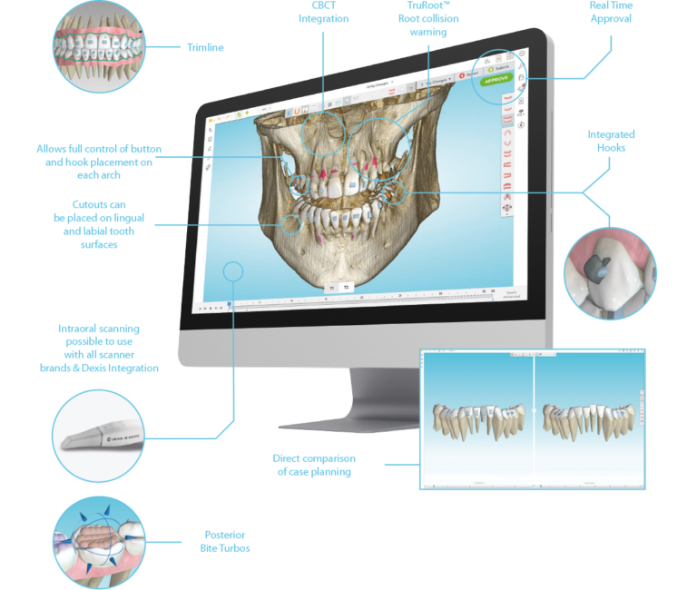 Ormco - Spark™ - Innovative & Advanced Clear Aligner System